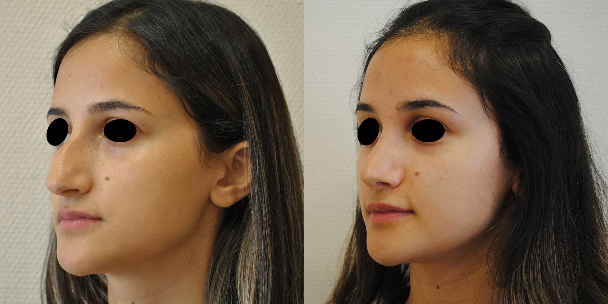 HNO Dr. Matthias Grabner - Ihr Spezialist für Nasenkorrektur ...