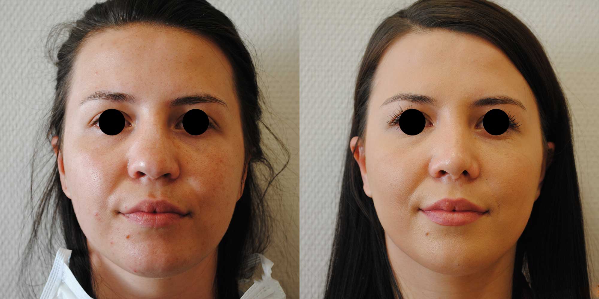 HNO Dr. Matthias Grabner - Ihr Spezialist für Nasenkorrektur ...