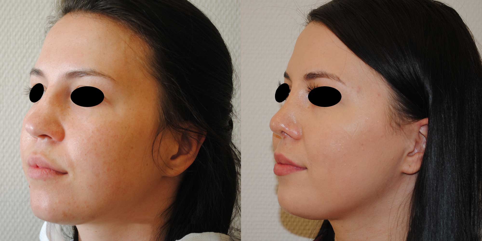 HNO Dr. Matthias Grabner - Ihr Spezialist für Nasenkorrektur ...