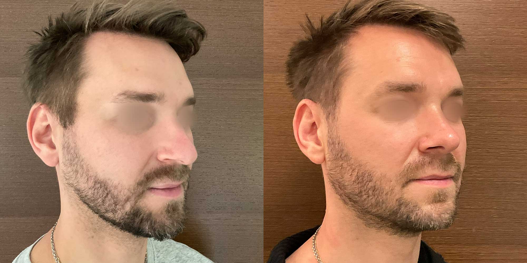 HNO Dr. Matthias Grabner - Ihr Spezialist für Nasenkorrektur ...