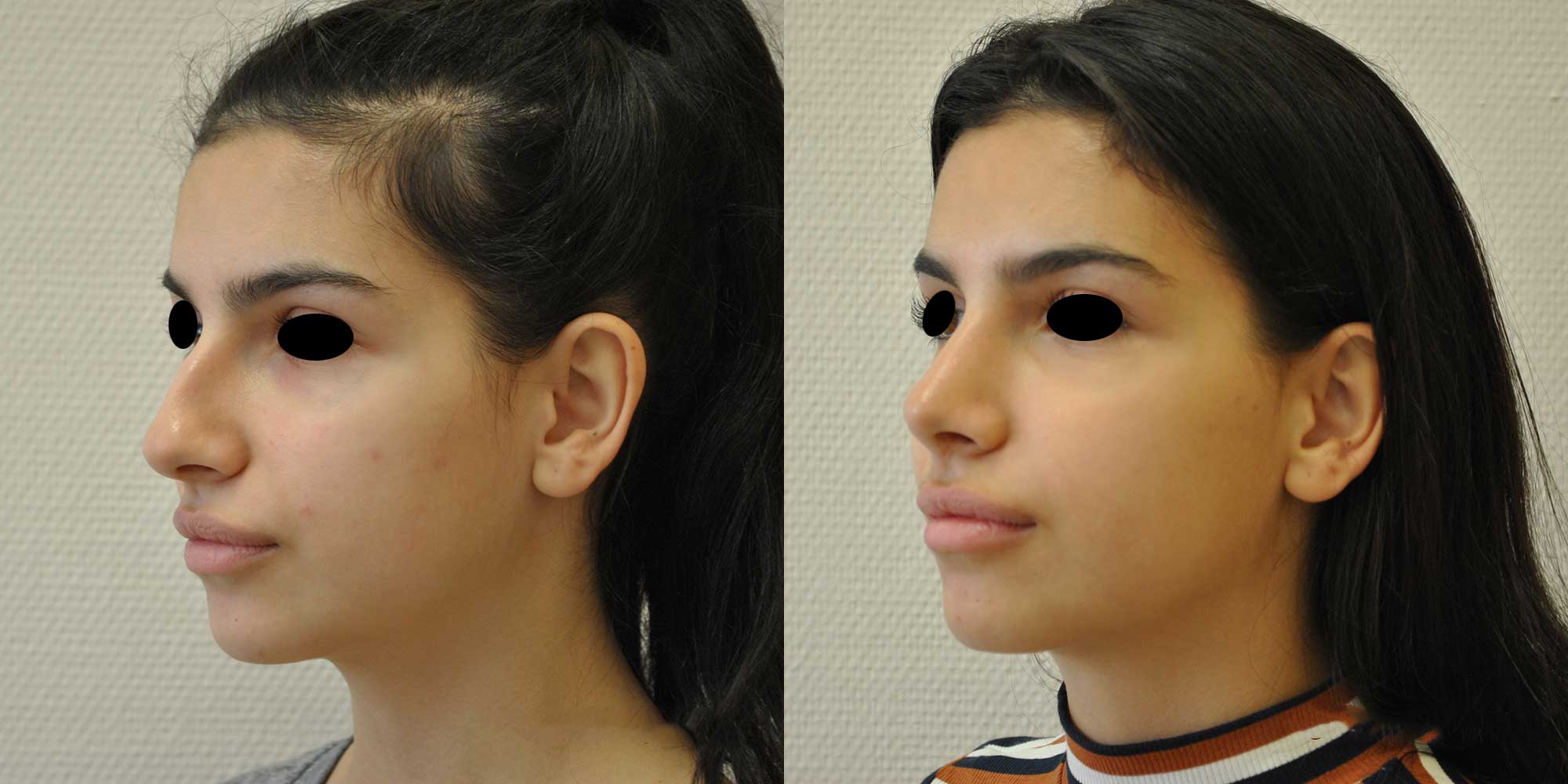 HNO Dr. Matthias Grabner - Ihr Spezialist für Nasenkorrektur ...