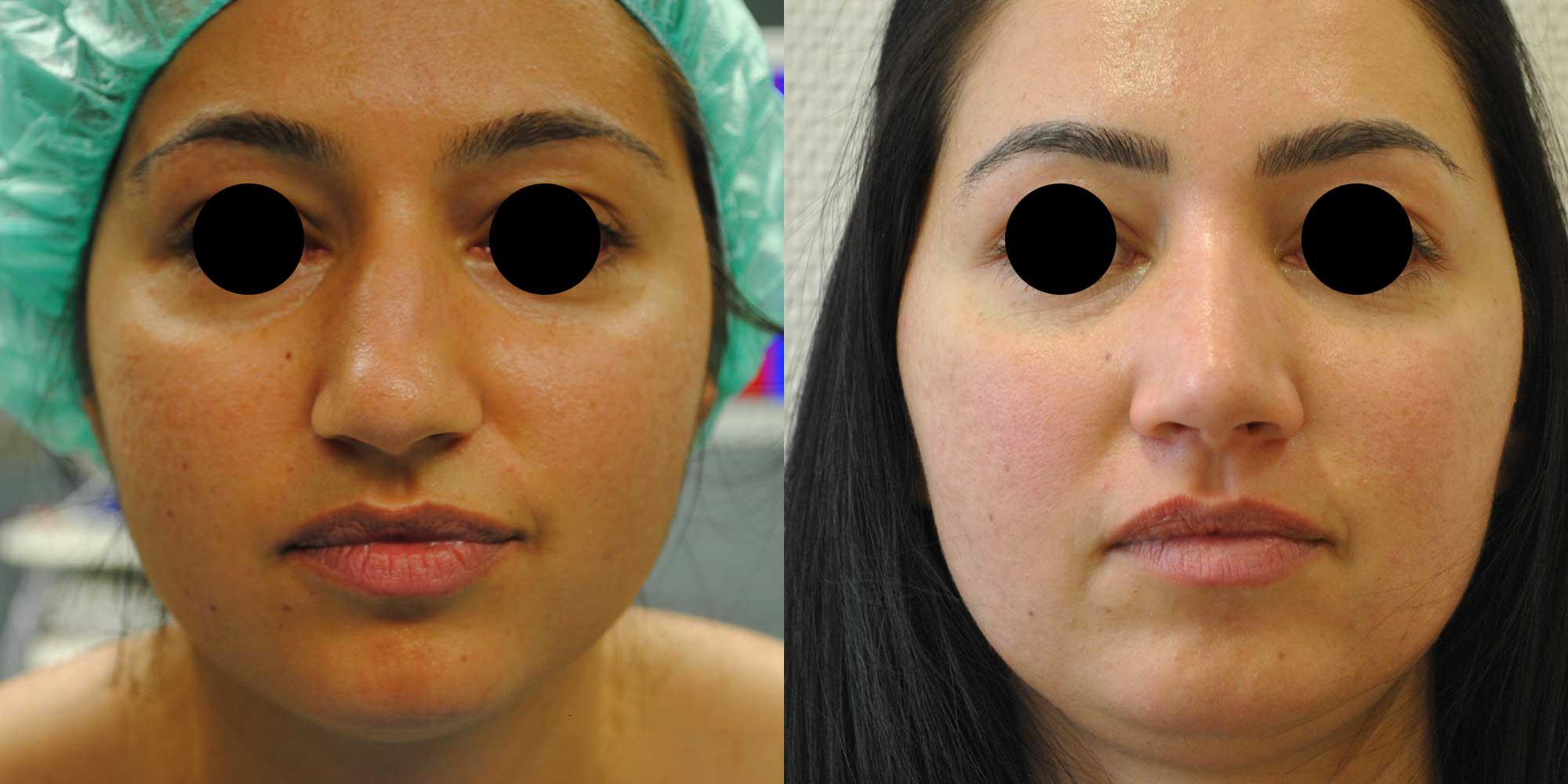 HNO Dr. Matthias Grabner - Ihr Spezialist für Nasenkorrektur ...