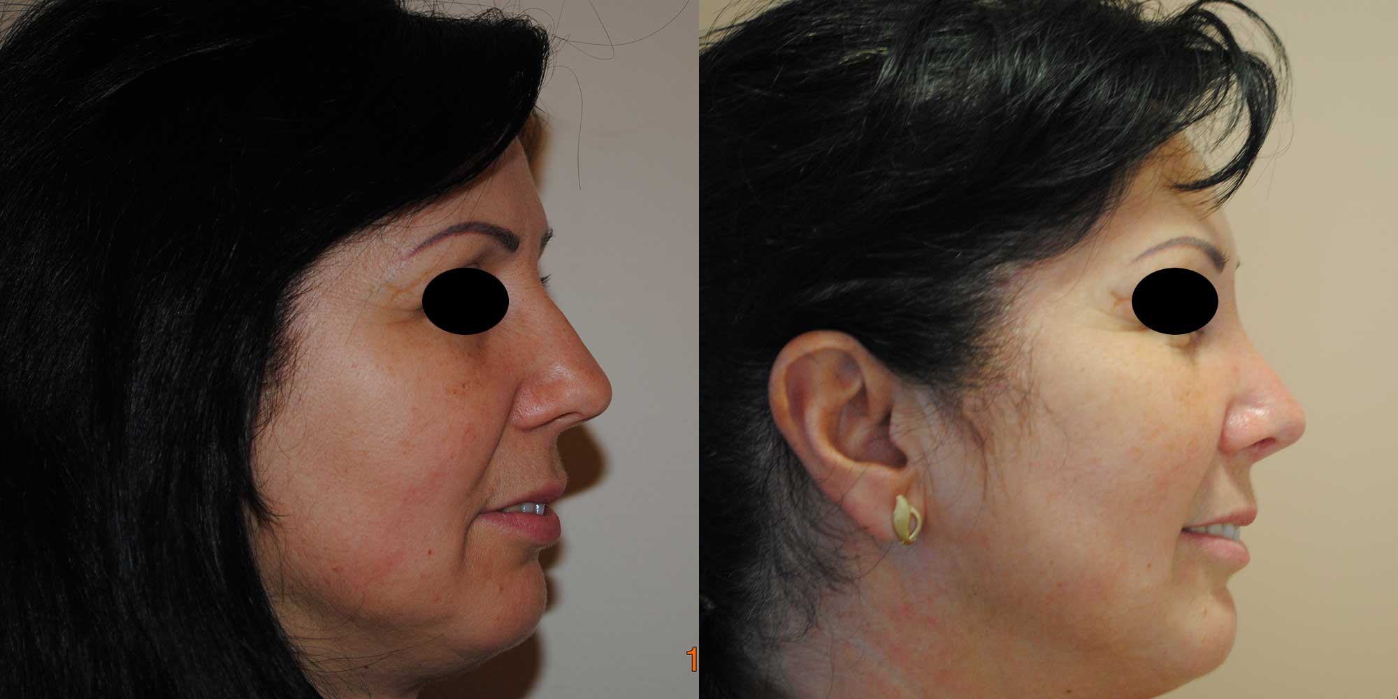 HNO Dr. Matthias Grabner - Ihr Spezialist für Nasenkorrektur ...