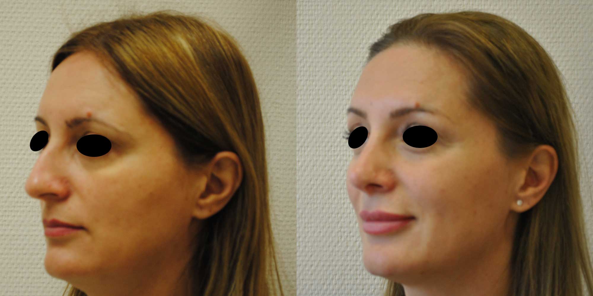 HNO Dr. Matthias Grabner - Ihr Spezialist für Nasenkorrektur ...